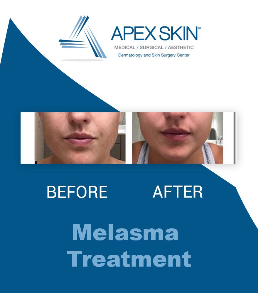 Melasma - How to Treat & Manage! - The Women's Journal