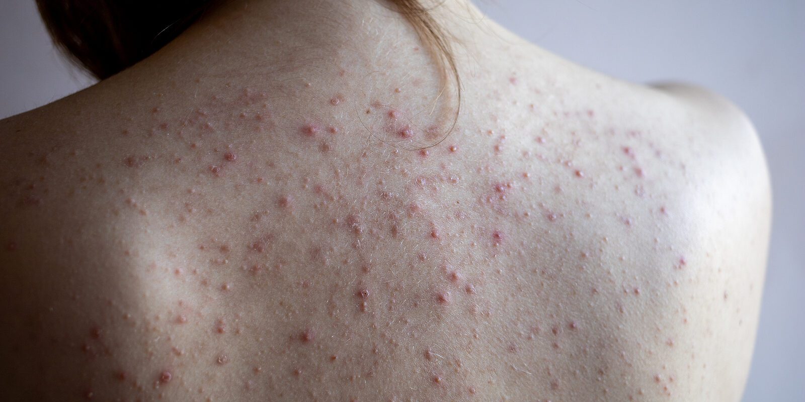 How to Get Rid of Body Acne - The Women's Journal